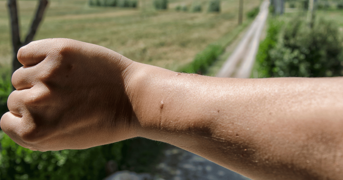 Calendeel plus | Hoe herken ik een spinnenbeet?