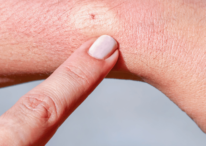 Calendeel plus | Bijen- en wespensteken herkennen