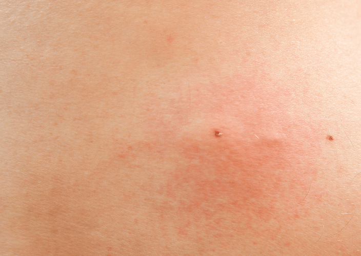 Calendeel plus | Bijen- en wespensteken herkennen